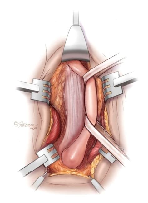 A Lambda Incision With The Patient In The Exaggerated Lithotomy