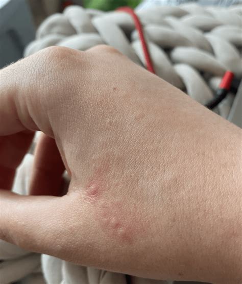 Woke Up With Tiny Bumps All Over Both Hands 2 Days Ago Not Itchy No