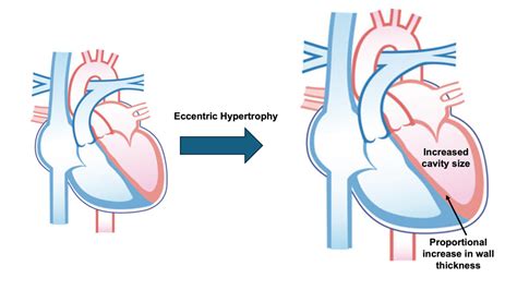 Concentric Versus Eccentric Training Of The Heart