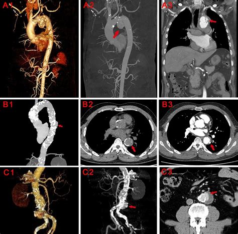 Examples Of Pau Pseudoaneurysm Evaluation A1 A3 Example Of Pau At
