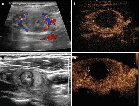 Ultrasound Of Thyroid Nodules Radiology Key My Xxx Hot Girl