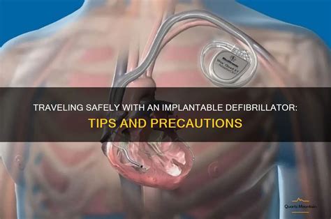 Traveling Safely With An Implantable Defibrillator Tips And