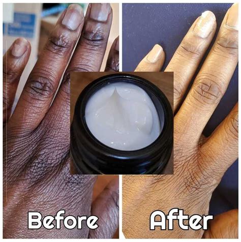 Dark Knuckle Treatment Cream Neck Ankles Knuckle Thighs Elbows Intimate Area Dark Body Whitening