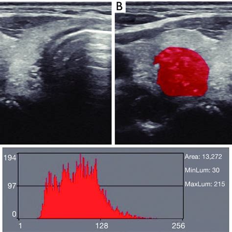A 33 Year Old Woman With A 13 Cm Diameter Suspicious Malignant Thyroid