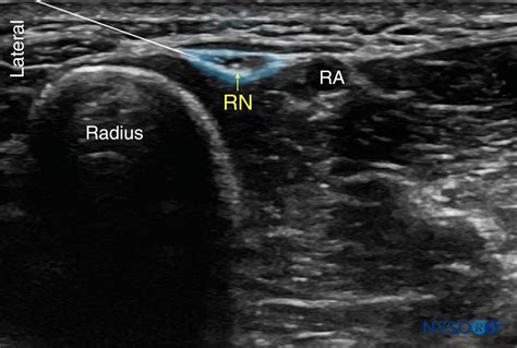 Ultrasound Guided Wrist Nerve Block Nysora