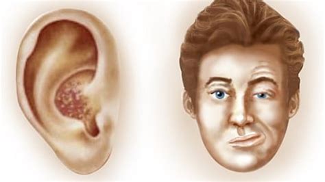Ramsay Hunt Syndrome Justin Biebers Facial Paralysis Explained