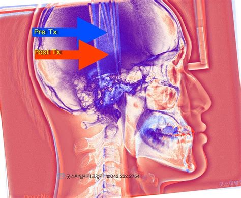 Severe Skeletal Class Iii Which Means Mandibular Excess Asymmetry