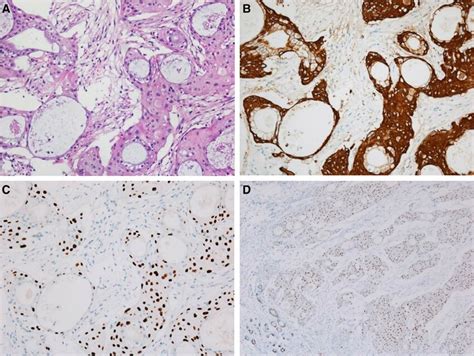 Histopathological Examination Confirmed Mec Of The Breast Intermediate