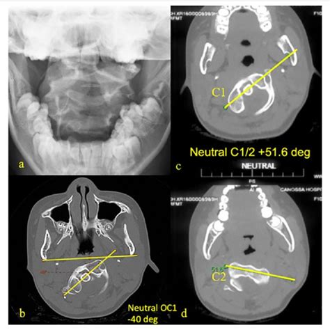 A Open Mouth View On Presentation B Occiput C1 Rotational