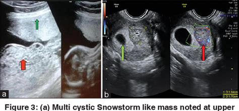 Role Of Ultrasonography In Molar Pregnancy Coexisting With Viable Fetus