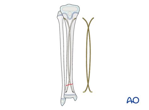 Elastic Nailing For Simple Complete Fracture Of The Distal Tibial