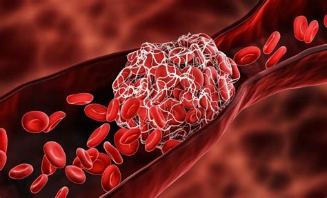 Eves Protocol Launched To Optimise Care Of Patients With Vte In