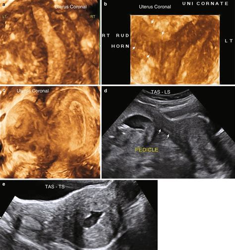 Ultrasound Evaluation Of Congenital Uterine Anomalies Springerlink