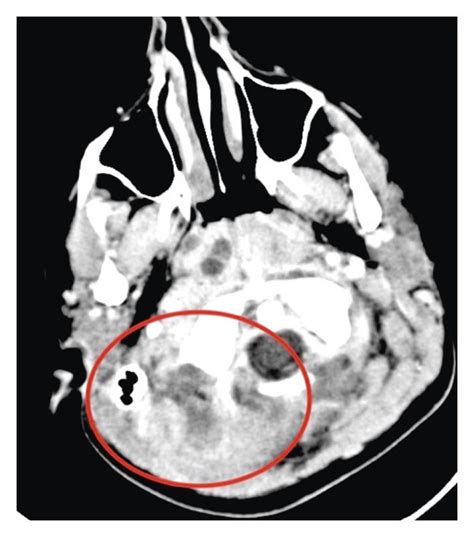 Irregular Hypodensity Below The Right Mastoid And Right Half Of The
