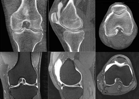 Standing Ct Vs Mri For Advanced Visualization Of Knee Cartilage And