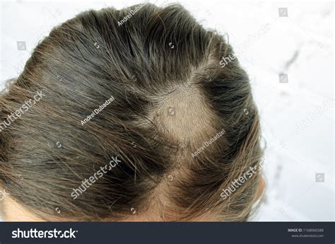 643 Parasites The Scalp Images Stock Photos Vectors Shutterstock