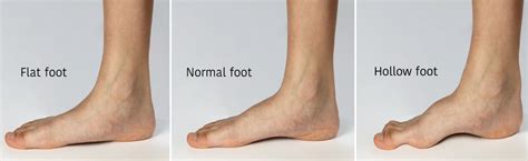 Should You Get Orthotics For Flat Feet Heres When They Actually Help