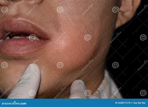 Single Swelling Or Lymph Node At The Neck Royalty Free Stock