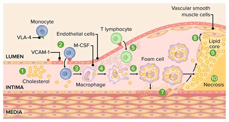 Atherosclerosis Concise Medical Knowledge