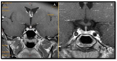 Radiological Improvement In Patient With Primary Hypophysitis