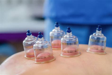 Woman Receiving Cupping Therapy On Her Back During A Physical Therapy