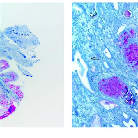 Thsd7a Shows Membranous And Cytoplasmic Staining Pattern A Tumor