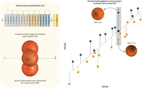 A More Negative Fundus Refraction Offset Was Associated With Lower