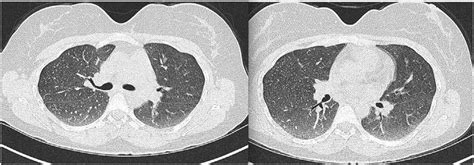 Diffuse Centrilobular Ground Glass Nodules Along The Bronchovascular