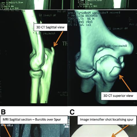 Pdf Endoscopic Extrabursal Excision Of Olecranon Spur