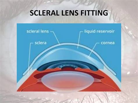 Scleral Contact Lens In Ophthalmology Pptx