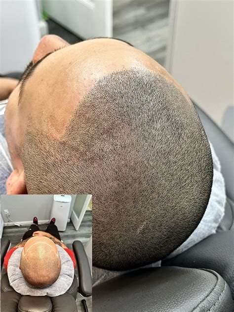 Nuhair Ink Scalp Micro Pigmentation Permanent Hair Loss Solution Nuhair Ink Scalp Micro Pigmentation Permanent Hair Loss Solution