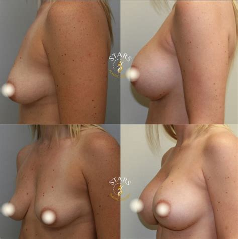 What Are Gummy Bear Breast Implants Cost Sizes And Benefits