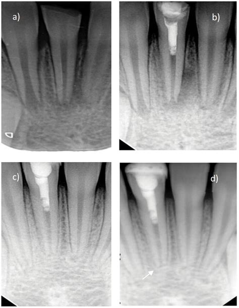 Tooth Periapical Lesion