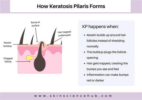 Keratosis Pilaris On Face Treatments Causes And What To Avoid