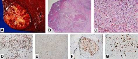 Controversies In The Spleen Surgical Pathology Clinics