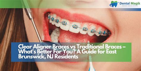 Clear Aligner Braces Vs Traditional Braces Dental Magik