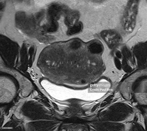 Uterine Adenomyosis And Leiomyomas Seen On Mri Magnetic Resonance Image