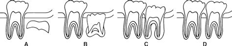 Stages A To D Of Third Molar Eruption Download Scientific Diagram