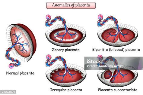 Anomalies Of Placenta Stock Illustration Download Image Now Placenta Amniotic Fluid