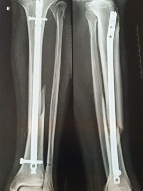 Fraturas Da Tíbia Fíbula E Patela