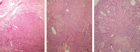 Two Patients With Marginal Symptoms Showing Hyperthecosis At The Edge Of Malignancy