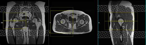 Mri Hip Mri Hip Unilateral Protocol And Planning