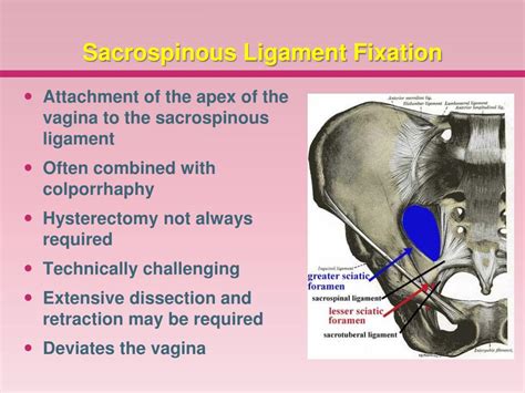 Ppt Innovative Treatment Options For Pelvic Organ Prolapse Powerpoint