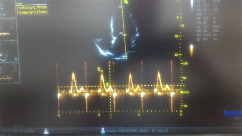 Diastolic Dysfunction Drsvenkatesan Md