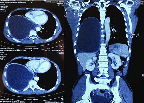 Ct Scan Showing Cyst In The Right Hemithorax Download Scientific Diagram