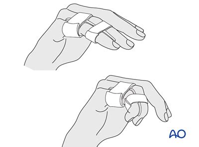 Nonoperative Treatment For Dorsal Avulsion Of The Proximal End Segment
