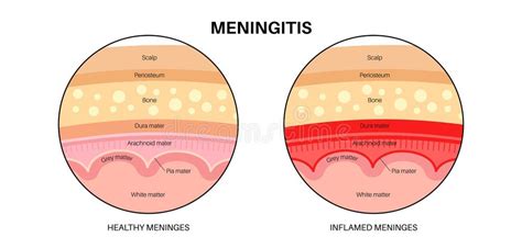 Meningitis Medical Poster Stock Vector Illustration Of Spinal 360243854