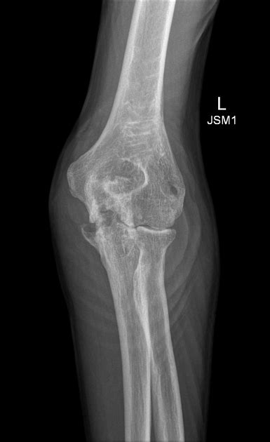 Elbow X Ray Ap X Ray Elbow Ap And Lateral Post Elbow Reconstruction