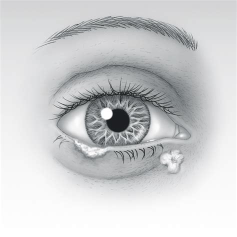 Periocular Skin Cancer