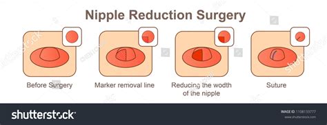 Nipple Reduction Surgery Stock Illustration 1108133777